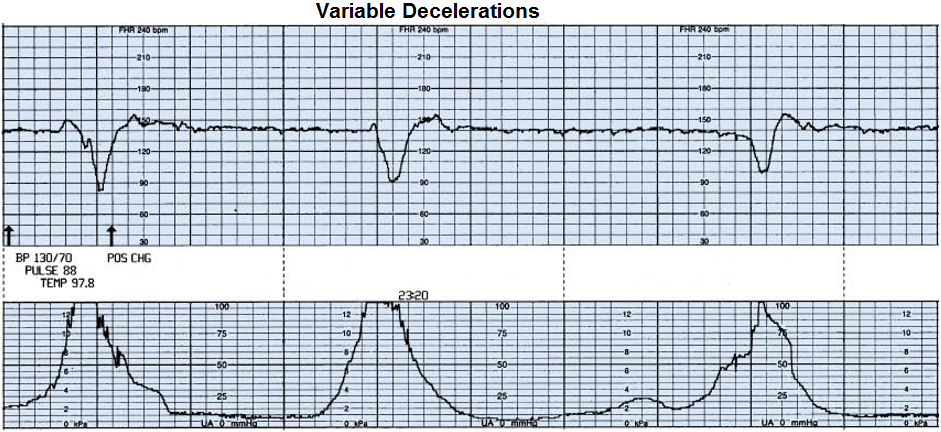 Variable Decelerations Explained